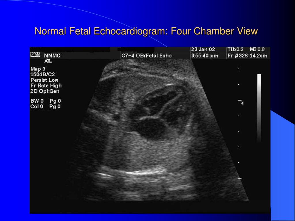 PPT - Diagnosis and Management of the Neonate With Critical Congenital ...