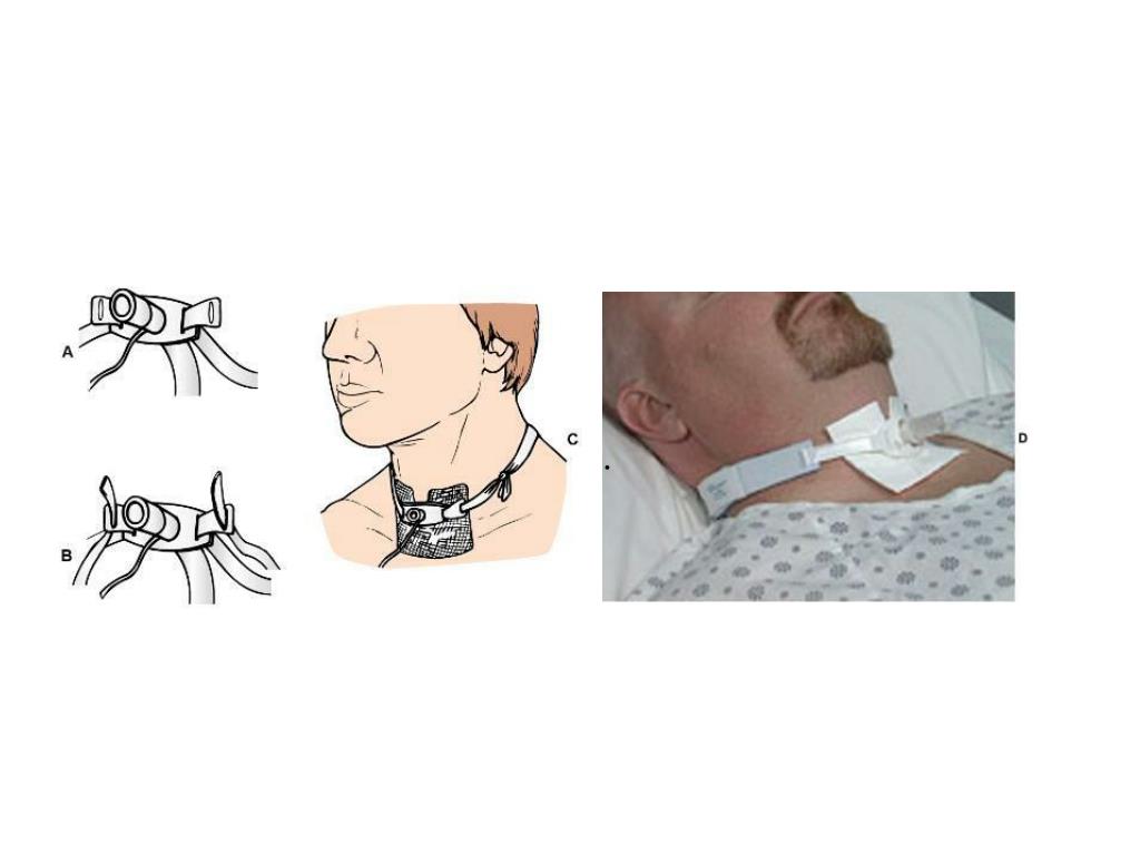 PPT - Tracheostomy Care and Suctioning Debbie Hogan RN Nursing 112 ...