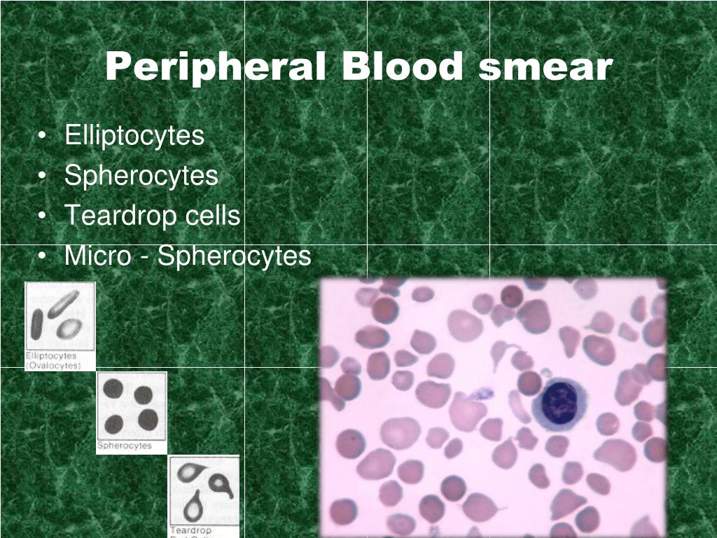 PPT - GROUP CASE STUDY Dr. Nancy McQueen MICR 410 - Hematology Spring ...