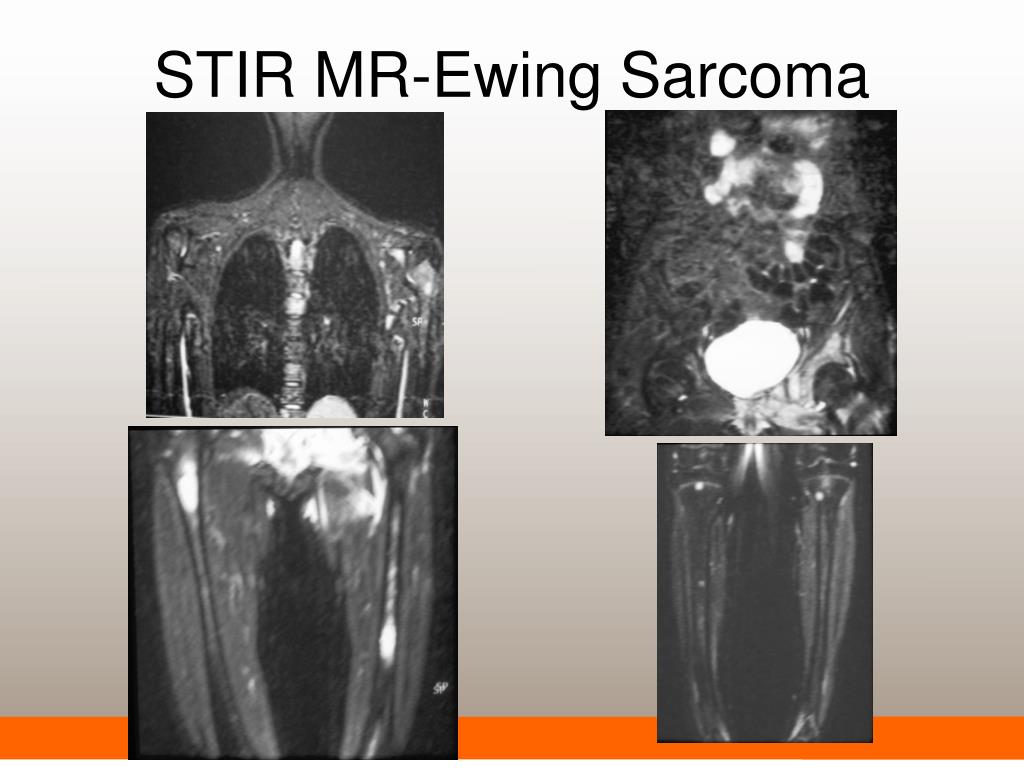 PPT - 6660: Whole-Body MRI in the Evaluation of Pediatric Malignancies ...