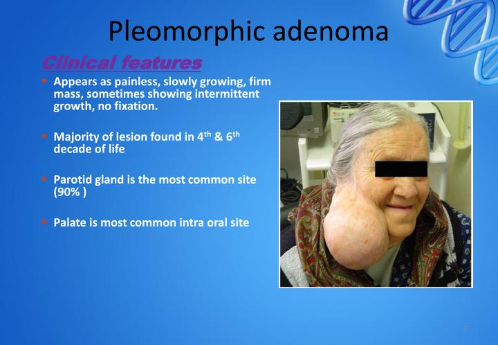 PPT - DISEASES OF SALIVARY GLAND PowerPoint Presentation - ID:6814832