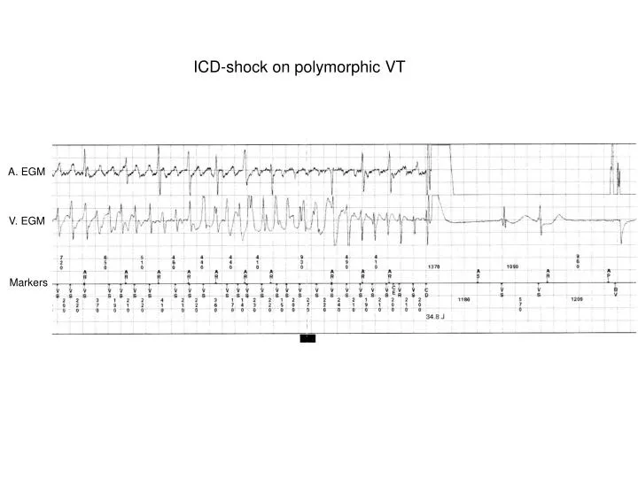 PPT - ICD-shock on polymorphic VT PowerPoint Presentation, free ...