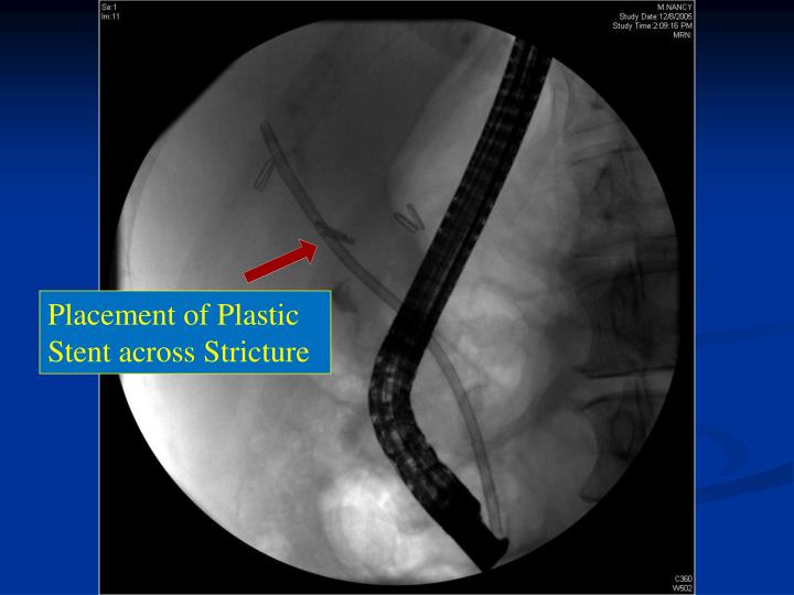 PPT - ERCP & Fluoro Quiz PowerPoint Presentation - ID:6818168