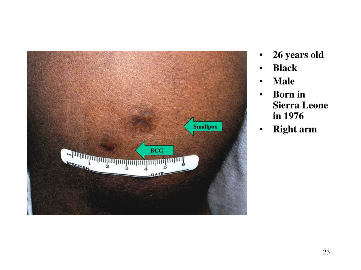 PPT - Recognition of BCG Scars PowerPoint Presentation - ID:6825234