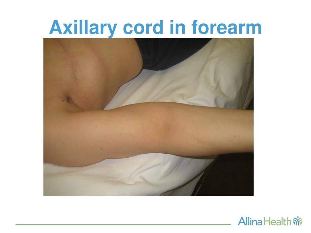 PPT - Breast Cancer Rehabilitation PowerPoint Presentation, free ...