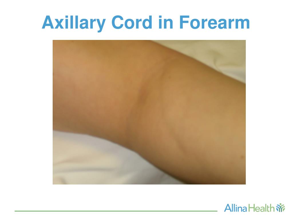 PPT - Breast Cancer Rehabilitation PowerPoint Presentation, free ...