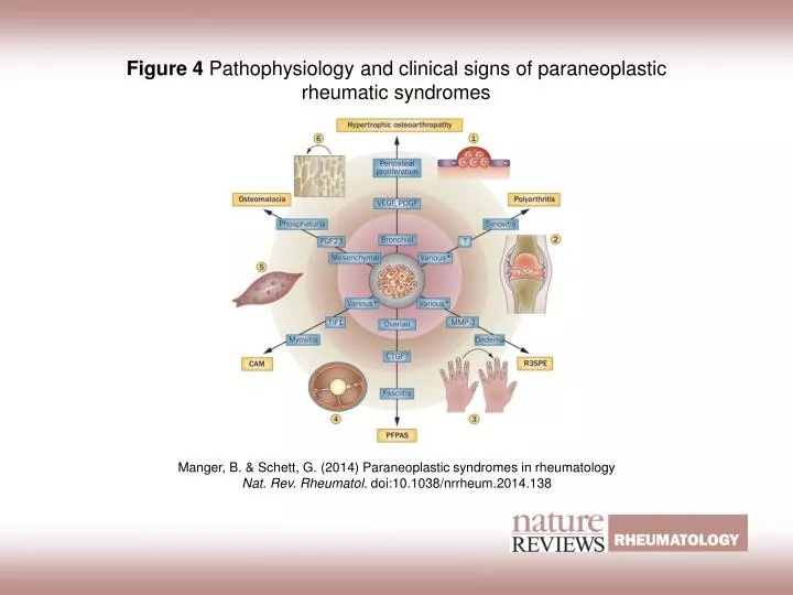 PPT - Figure 4 Pathophysiology and clinical signs of paraneoplastic ...