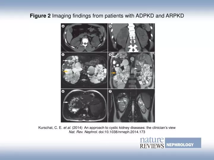 PPT - Figure 2 Imaging findings from patients with ADPKD and ARPKD ...
