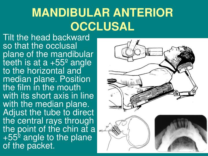 PPT - OCCLUSAL EXPOSURE TECHNIQUES PowerPoint Presentation - ID:6862351