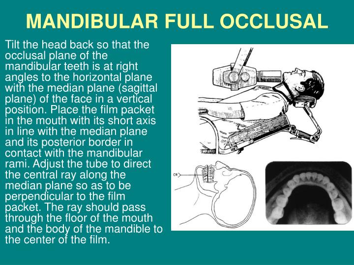 PPT - OCCLUSAL EXPOSURE TECHNIQUES PowerPoint Presentation - ID:6862351