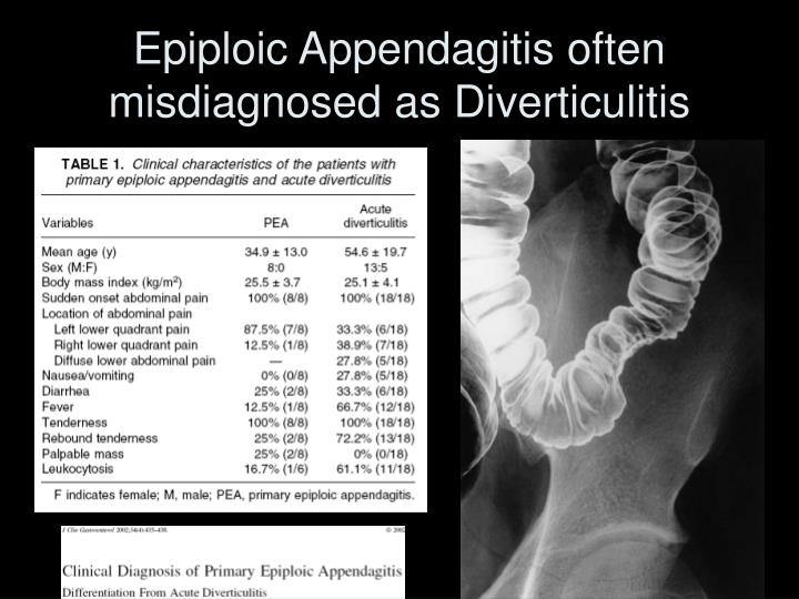 Epiploic Appendagitis Treatment