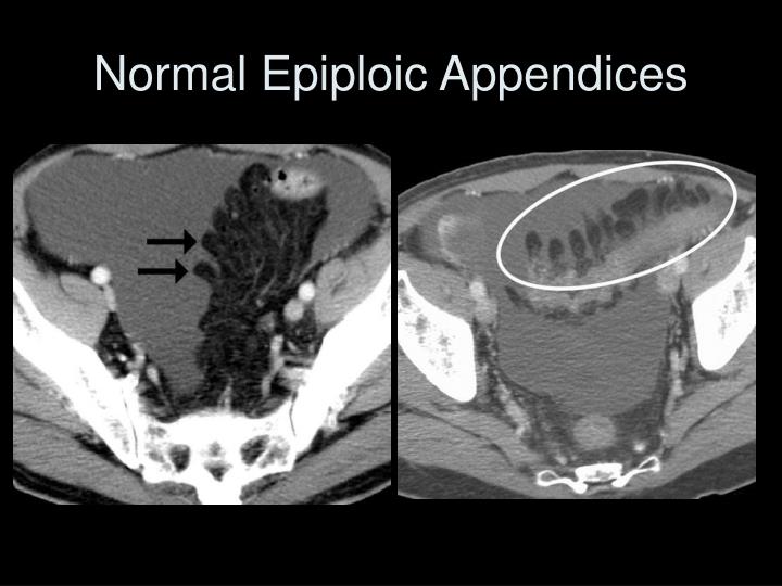 PPT - Omental Infarction and Epiploic Appendagitis PowerPoint ...