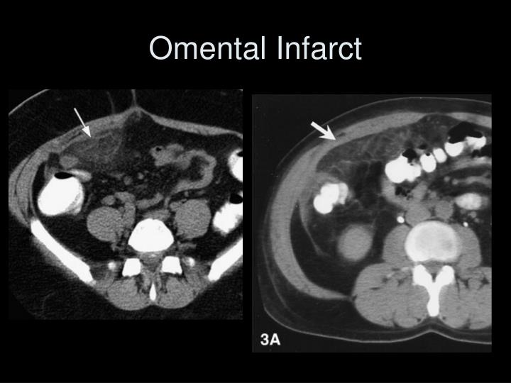 PPT - Omental Infarction and Epiploic Appendagitis PowerPoint ...