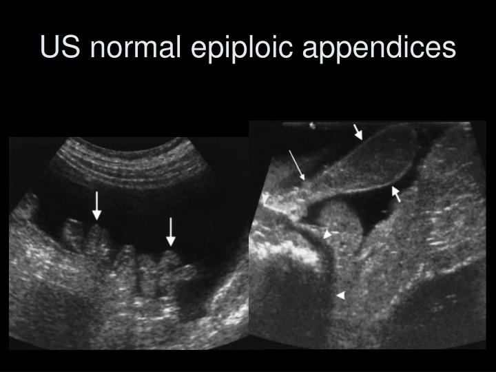 PPT - Omental Infarction and Epiploic Appendagitis PowerPoint ...