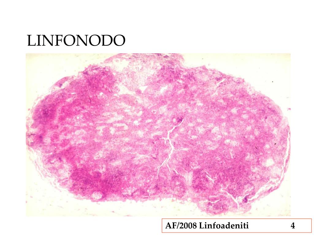 PPT - A Fassina Patologia Linfonodale PowerPoint Presentation, free ...