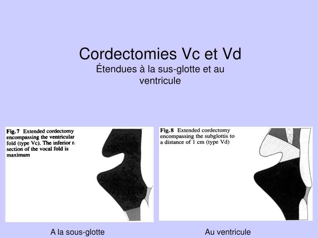 PPT - Cancer du larynx et chirurgie partielle PowerPoint Presentation ...