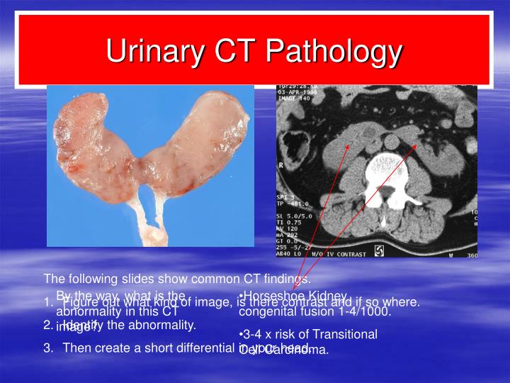 PPT - CT Anatomy and Pathology of the Urinary System, Adrenal Glands ...