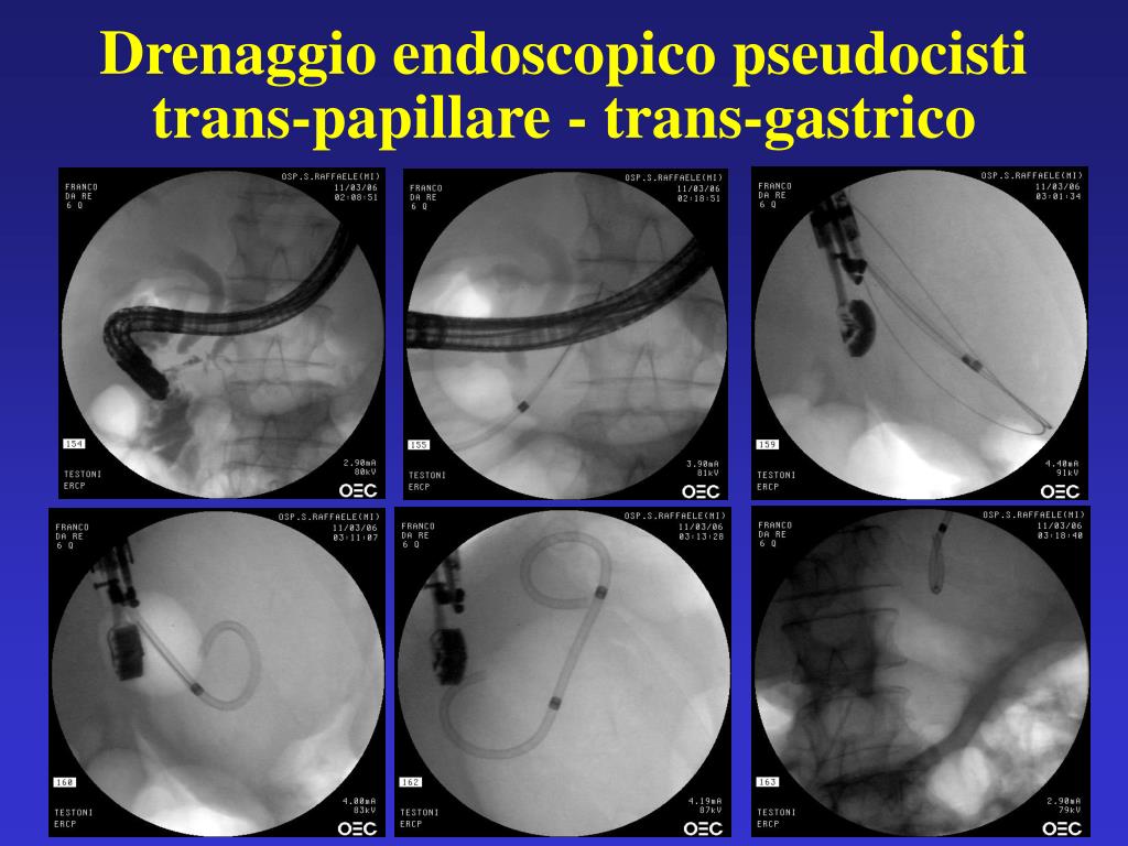 PPT - LESIONI CISTICHE PANCREATICHE PowerPoint Presentation, free ...