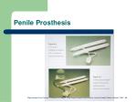 PPT - Erectile Dysfunction PowerPoint Presentation - ID:6871961
