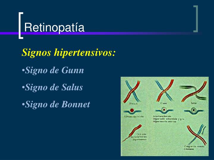PPT - Retinopatía Hipertensiva PowerPoint Presentation - ID:6873691