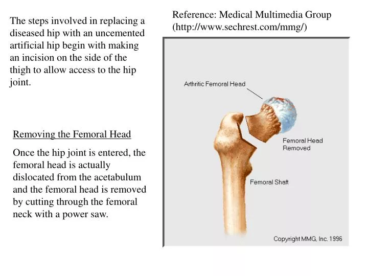 PPT - Removing the Femoral Head PowerPoint Presentation, free download ...