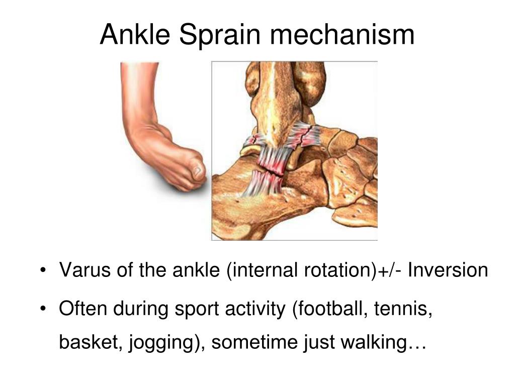 Ppt Ankle Sprain Powerpoint Presentation Free Download Id6877000