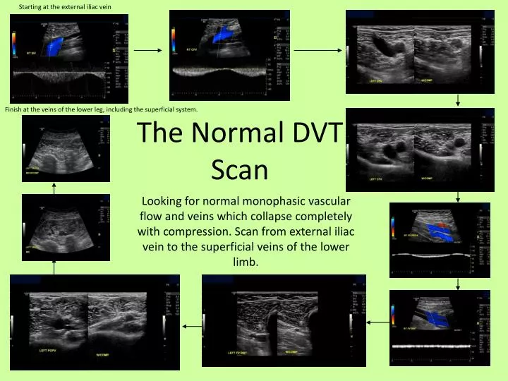 PPT - The Normal DVT Scan PowerPoint Presentation, free download - ID ...