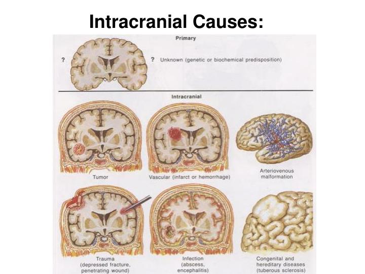 PPT - 1 . Electroencephalography Definition PowerPoint Presentation ...