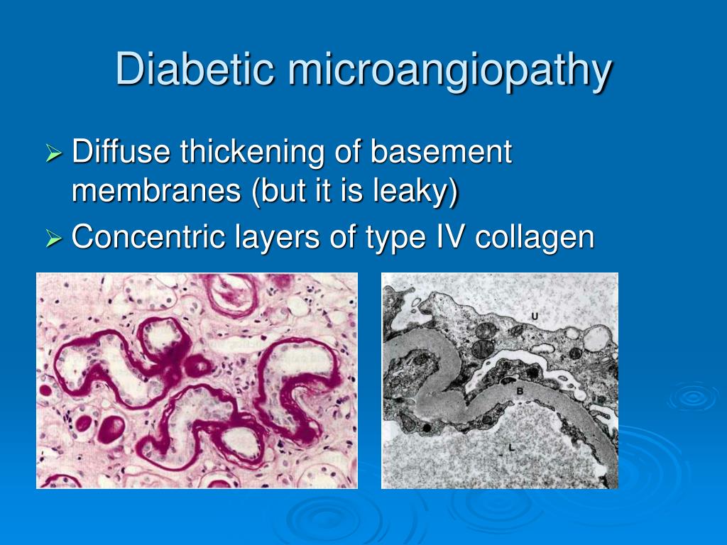PPT - Diabetes mellitus complications & morphology PowerPoint ...