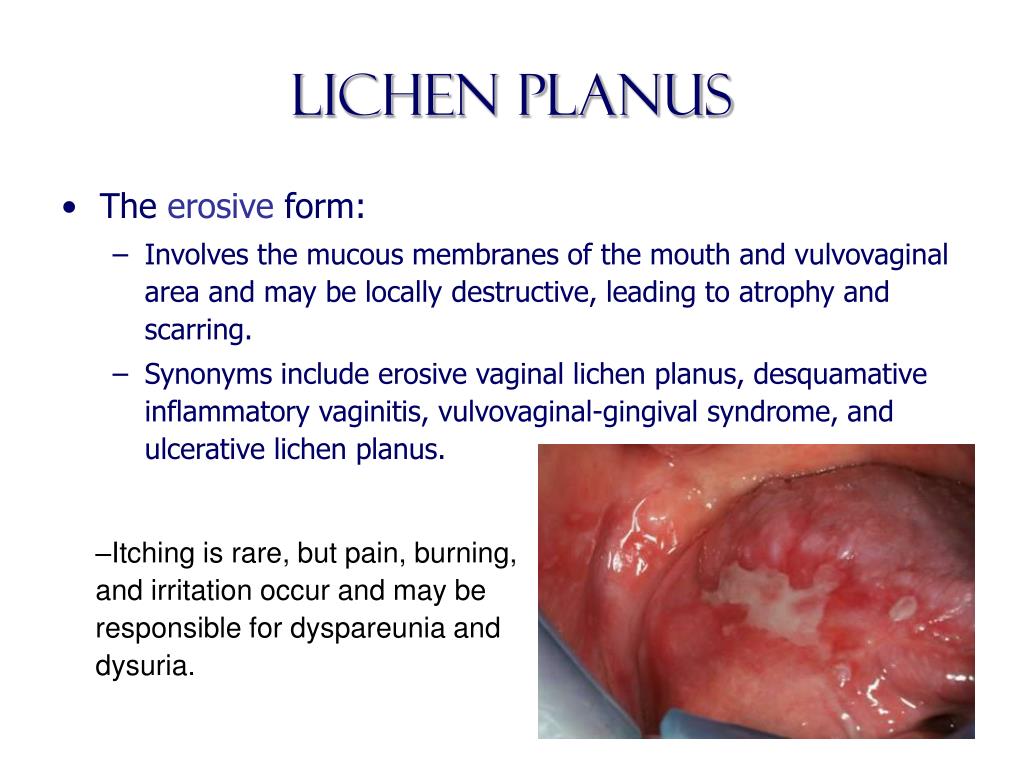 Ppt Benign Diseases Of The Vulva Vagina And Cervix Powerpoint