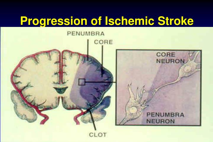 PPT - Thrombolysis and Beyond: The New Therapeutic Horizons for Acute ...