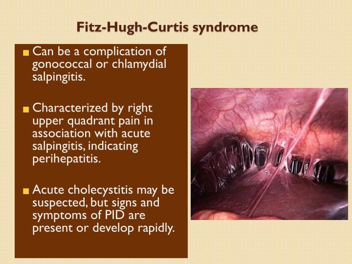 PPT - Pelvic Inflammatory Disease PowerPoint Presentation - ID:6895935