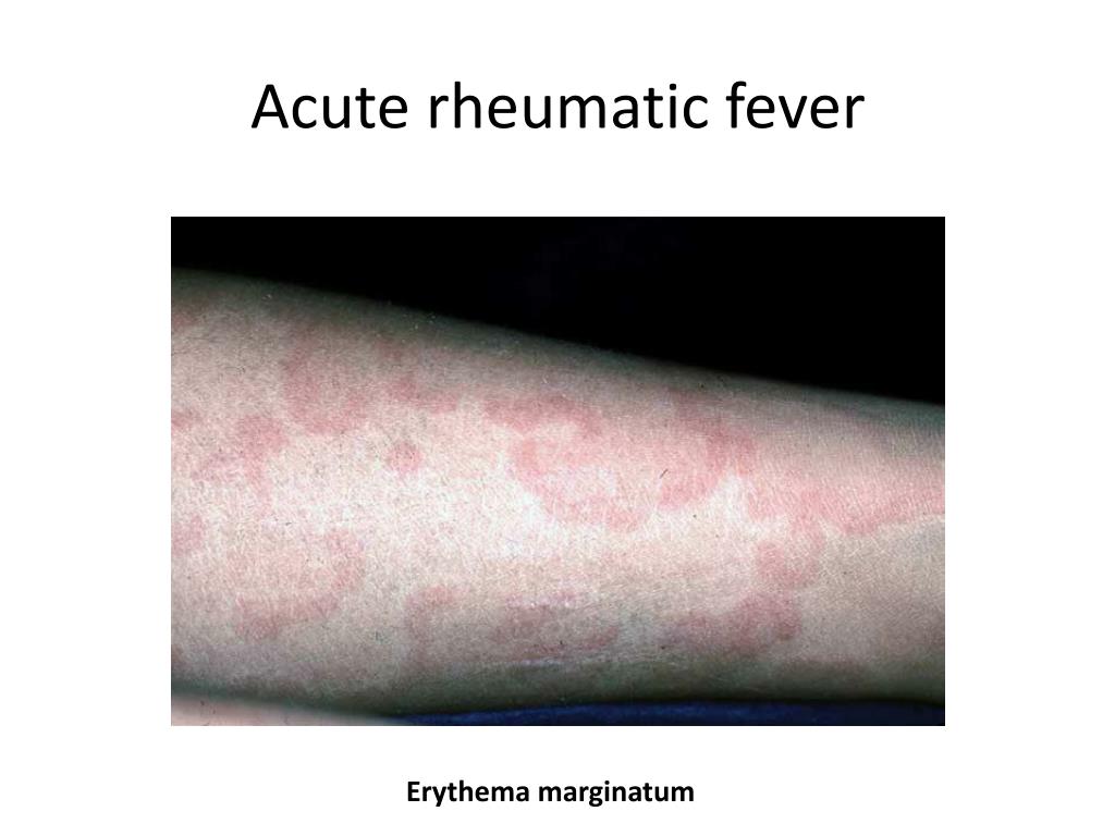 PPT - Cutaneous Manifestation of Cardiovascular Disease PowerPoint ...