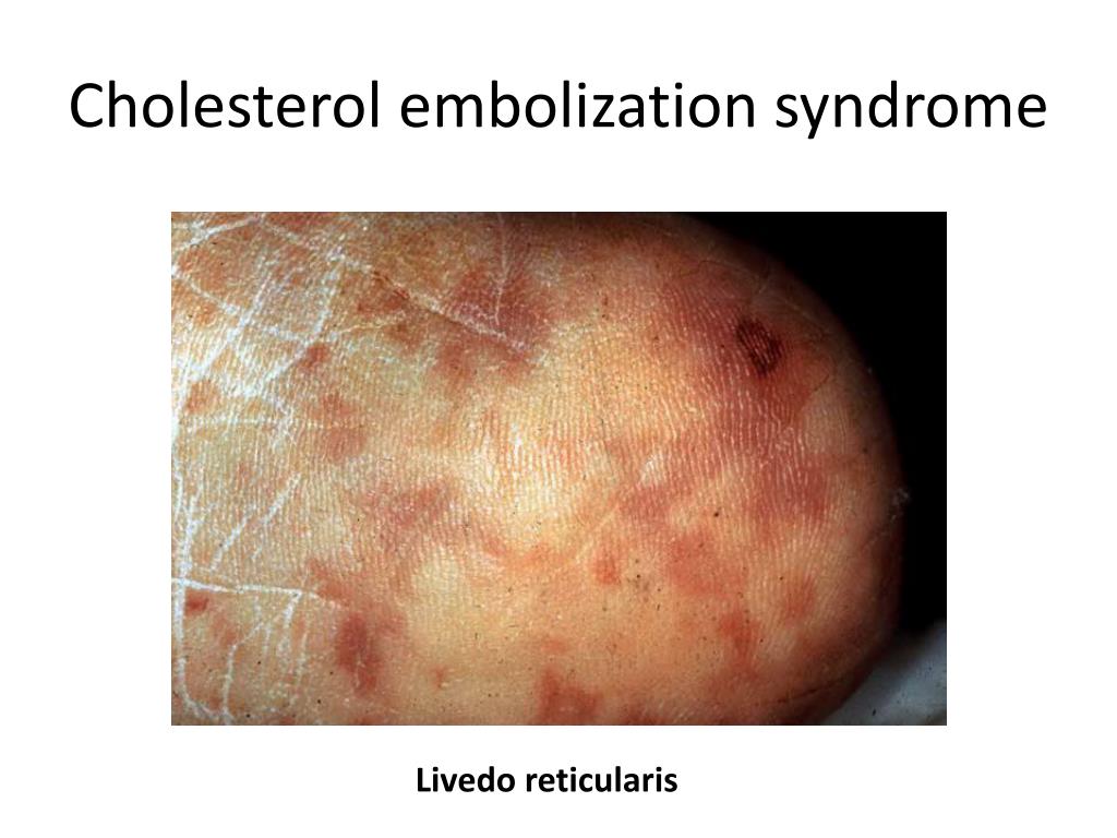 PPT - Cutaneous Manifestation of Cardiovascular Disease PowerPoint ...