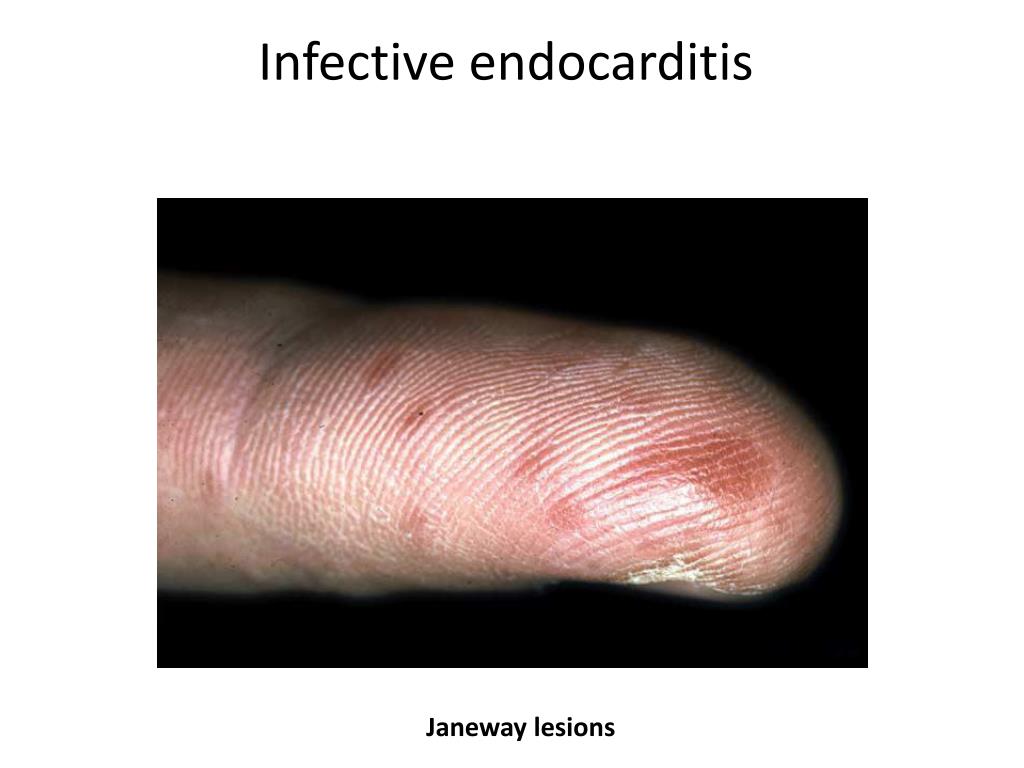 PPT - Cutaneous Manifestation of Cardiovascular Disease PowerPoint ...