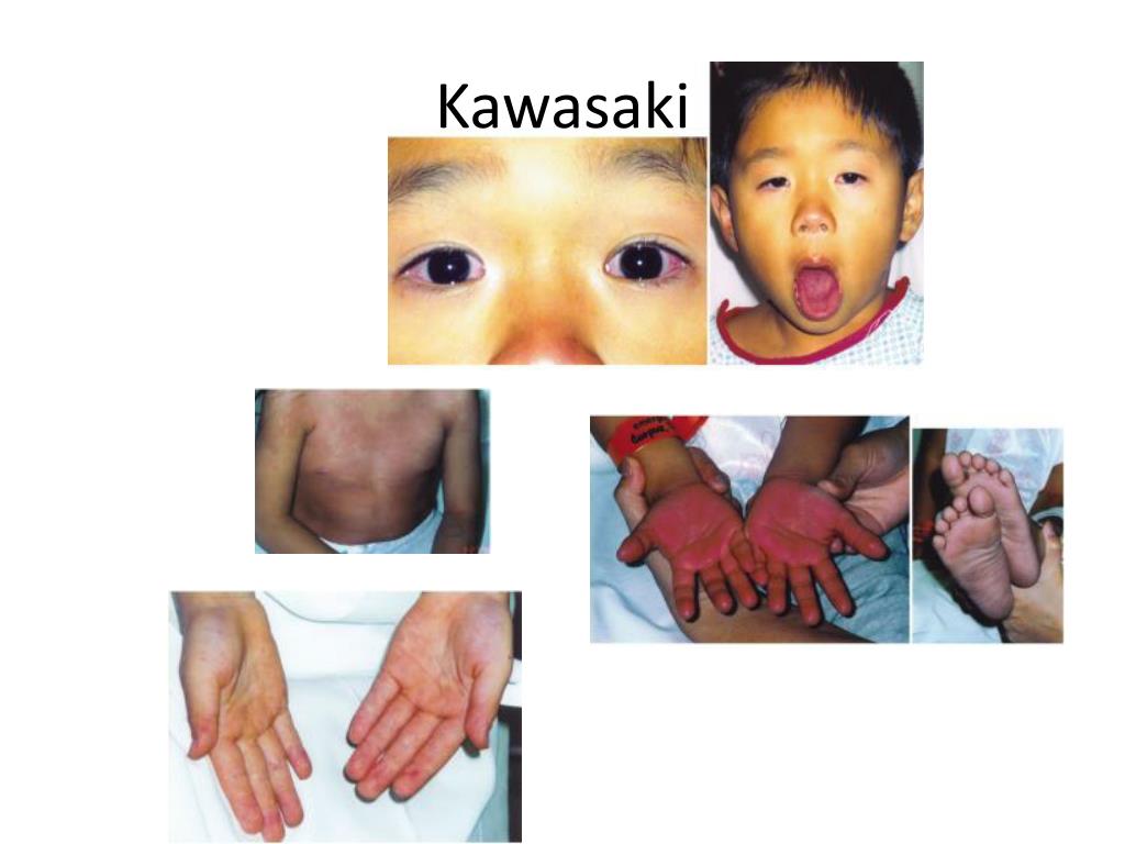 PPT - Cutaneous Manifestation of Cardiovascular Disease PowerPoint ...