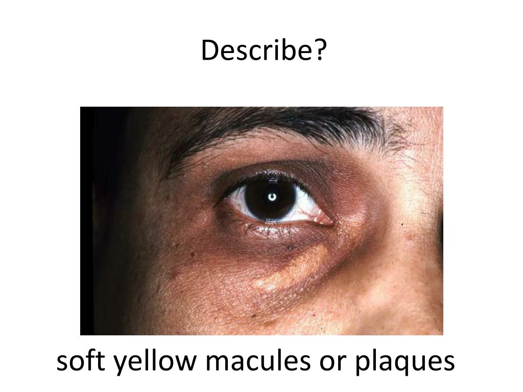 PPT - Cutaneous Manifestation of Cardiovascular Disease PowerPoint ...