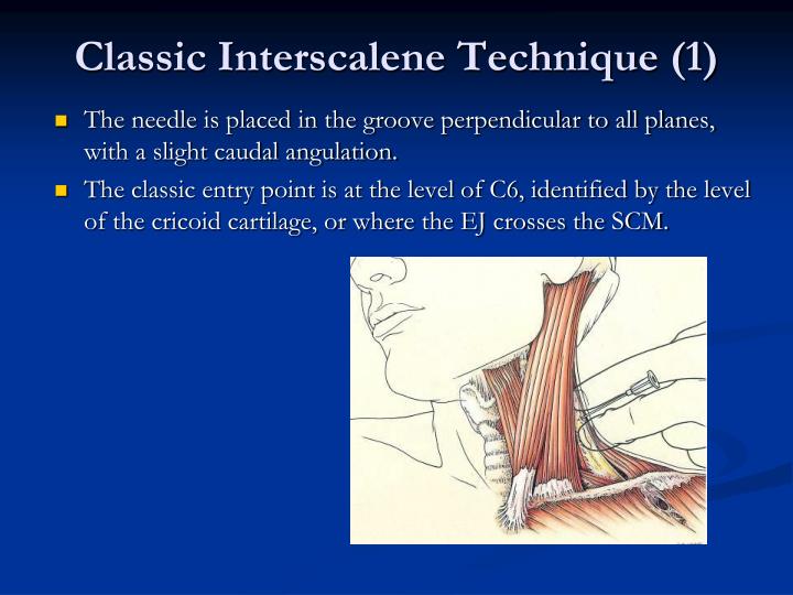 PPT - Supraclavicular and Interscalene Blocks PowerPoint Presentation ...