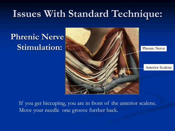 PPT - Supraclavicular and Interscalene Blocks PowerPoint Presentation ...