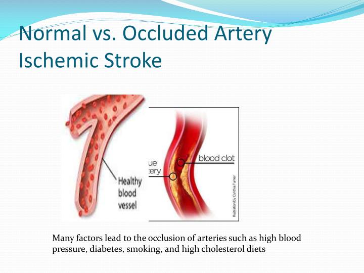PPT - Stroke Awareness PowerPoint Presentation - ID:6903959