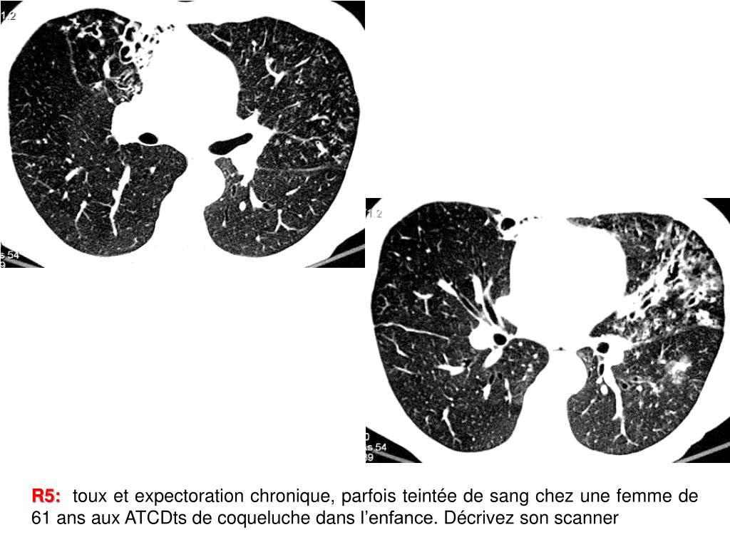 PPT - Interprétez l’ECG. Quelle est la cause la plus probable de cet ...