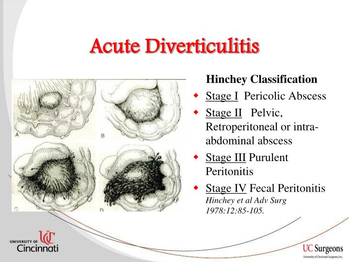 PPT - Practice Parameters for Sigmoid Diverticulitis PowerPoint ...