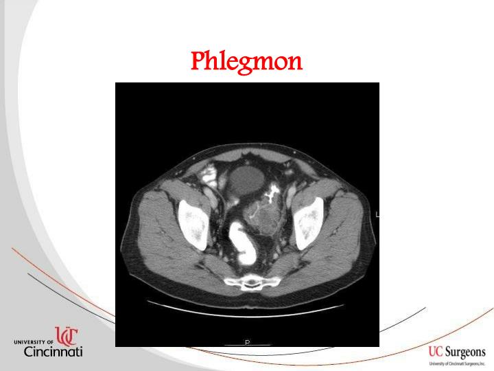 PPT - Practice Parameters for Sigmoid Diverticulitis PowerPoint ...