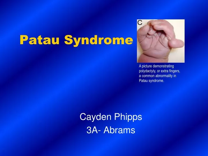 PPT - Patau Syndrome PowerPoint Presentation, free download - ID:6905046