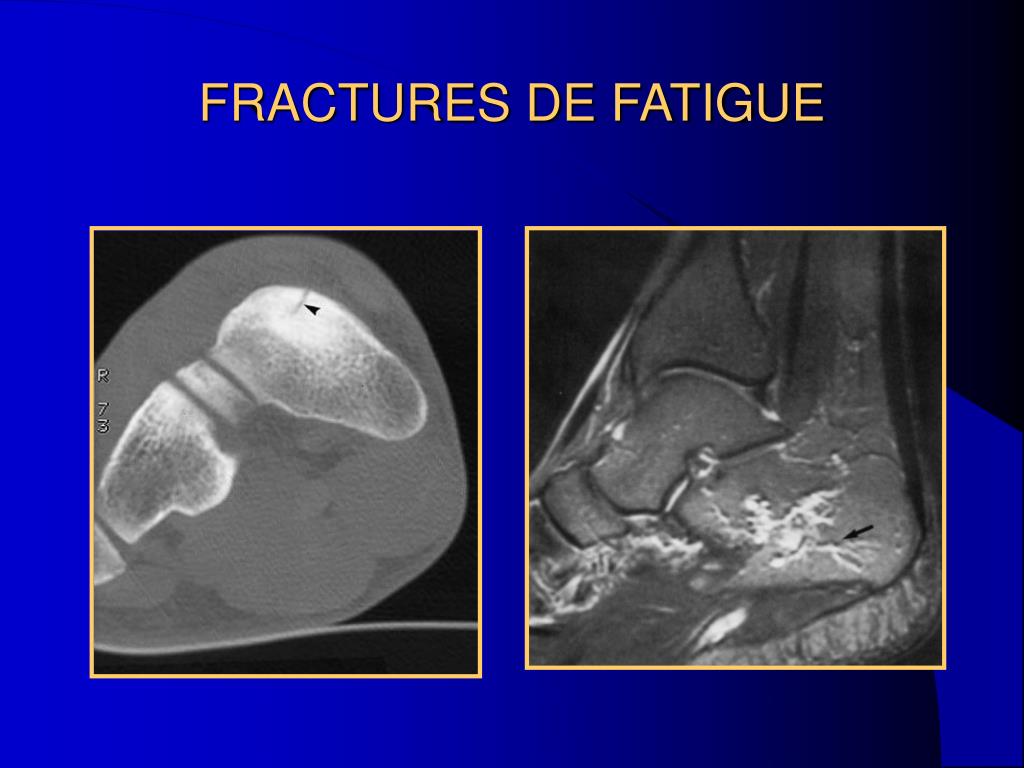 PPT - FRACTURES DU PIED Quels examens choisir ? M.F LADEB, H.MIZOUNI, K ...