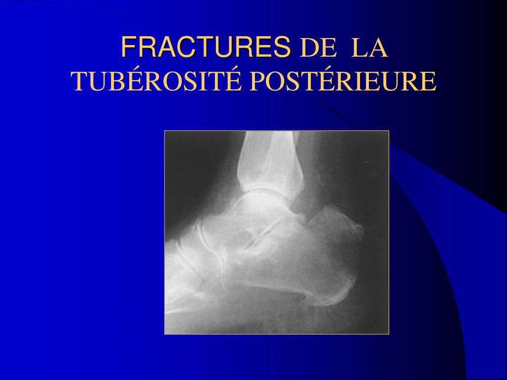 PPT - FRACTURES DU PIED Quels examens choisir ? M.F LADEB, H.MIZOUNI, K ...