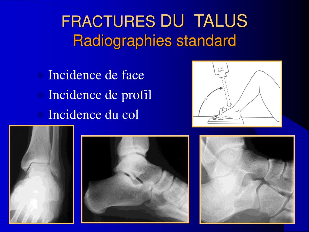 PPT - FRACTURES DU PIED Quels examens choisir ? M.F LADEB, H.MIZOUNI, K ...
