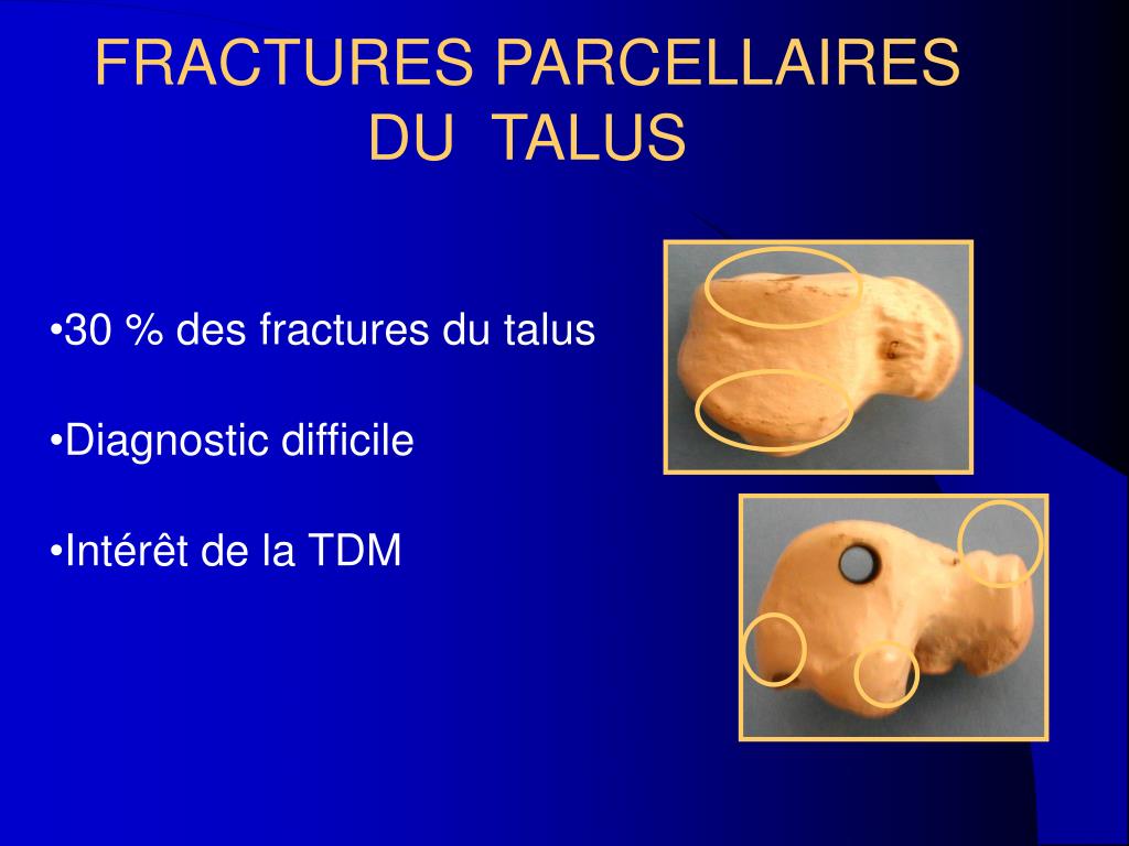 PPT - FRACTURES DU PIED Quels examens choisir ? M.F LADEB, H.MIZOUNI, K ...