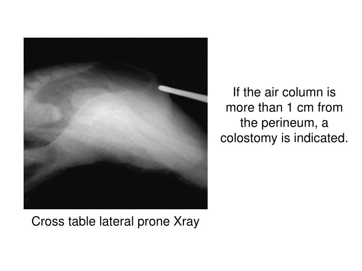 Xray Crosstable Lateral Film With The Baby In Prone How To Diagnose