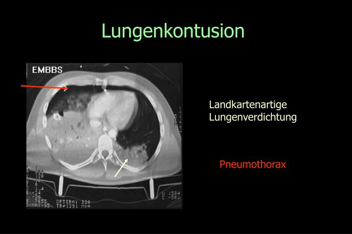 PPT - Thoraxtrauma PowerPoint Presentation - ID:6947283